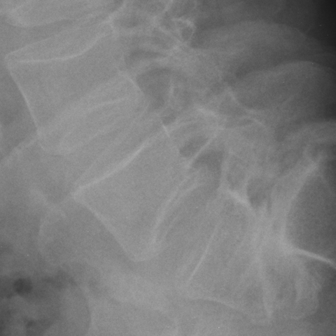 grade4spondy – Parramatta Chiropractic & Health Centre